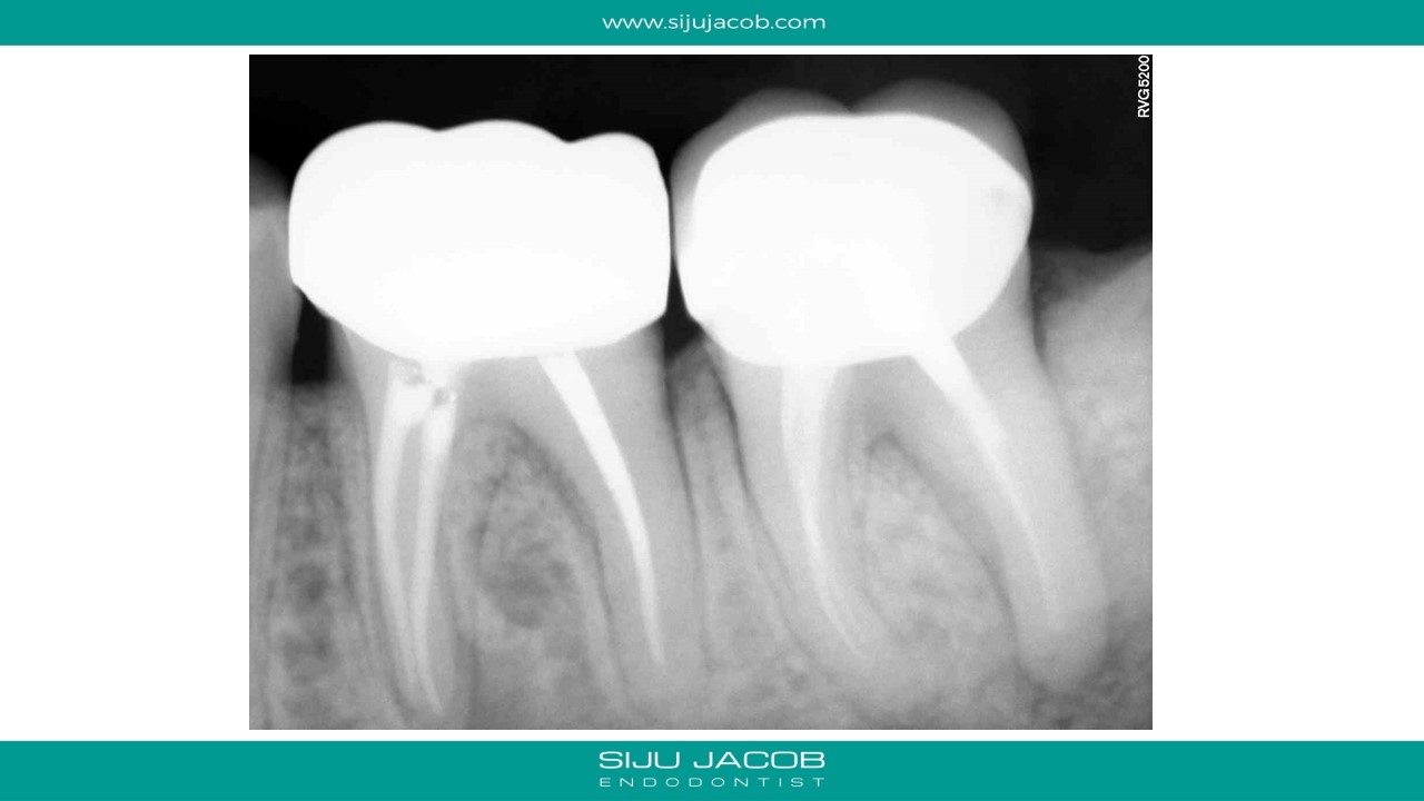 Selective Re-treatment of Distal root