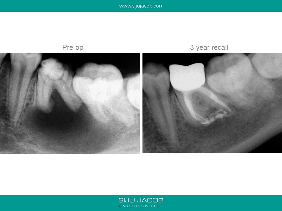 Pre-implant Endodontics