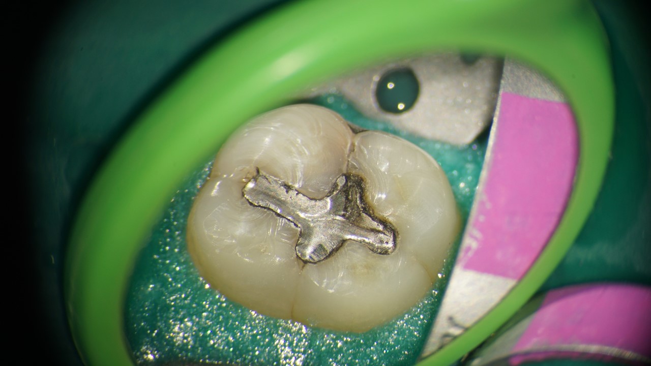 Easy case – single visit endo