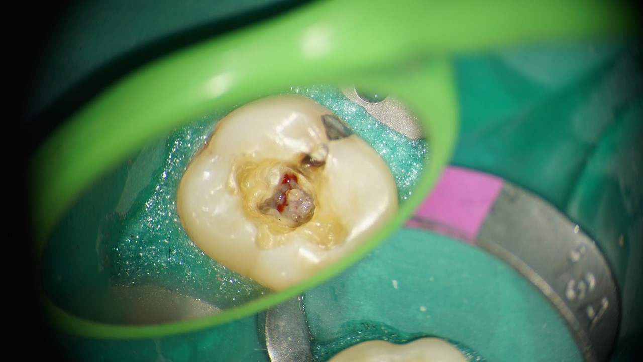 Easy case – single visit endo