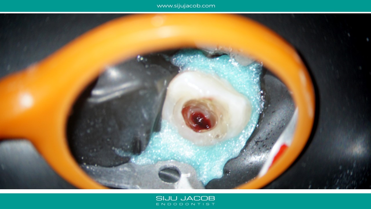Dens invaginatus: Non-surgical Endo