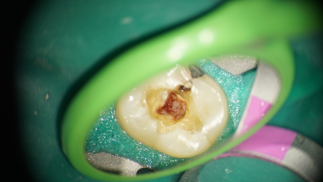 Easy case – single visit endo