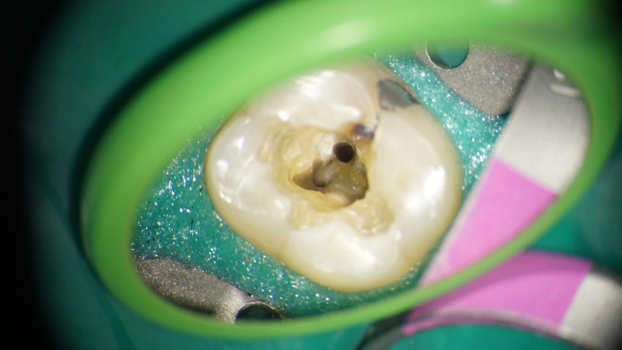 Easy case – single visit endo