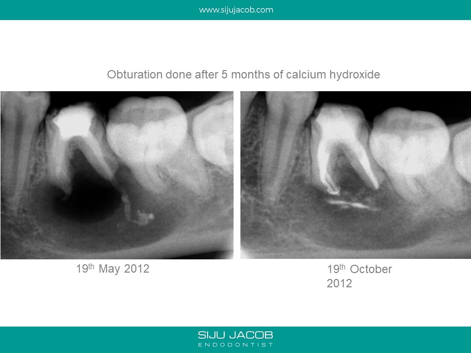 Pre-implant Endodontics